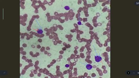 Reactive Lymphocyte Youtube