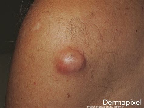 LIPOMA Síntomas Diagnóstico Tratamiento Y Pronóstico bolas Bultos