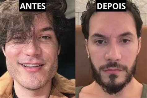 Revers O Da Harmoniza O Facial Famosos Buscam Apar Ncia Mais Natural