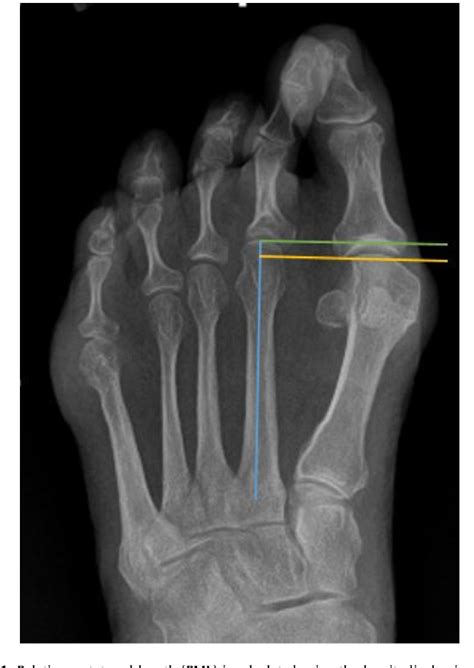 Figure 1 From First Tarsometatarsal Joint Fusion For Hallux Valgus