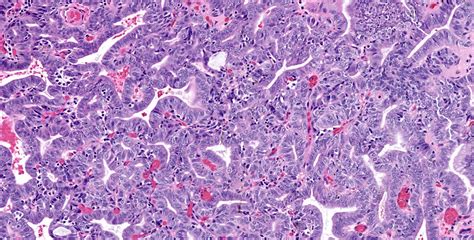 Pathology Outlines Intracholecystic Tubular Nonmucinous Neoplasm ICTN