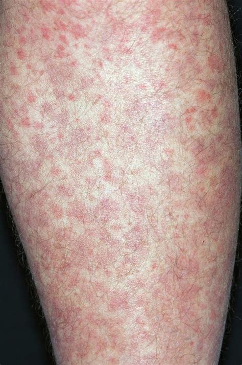Allergic Purpura On The Leg Photograph By Dr P Marazziscience Photo Library