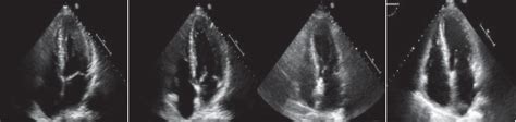 figure 1 from echocardiography segmentation based on a shape guided deformable model driven by a