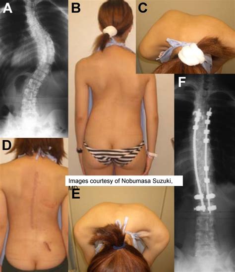Adolescent Idiopathic Scoliosis To Operate Or Not A Debate Article