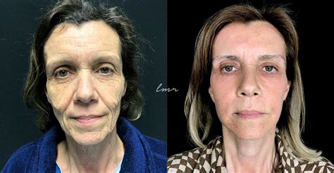 Facelift Lifting Facial Lisboa E Porto