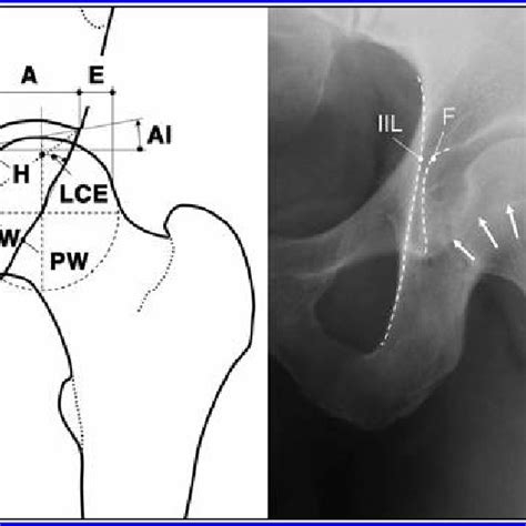 Schematic Left And Radiographic Right Appearances Of Normal Hip