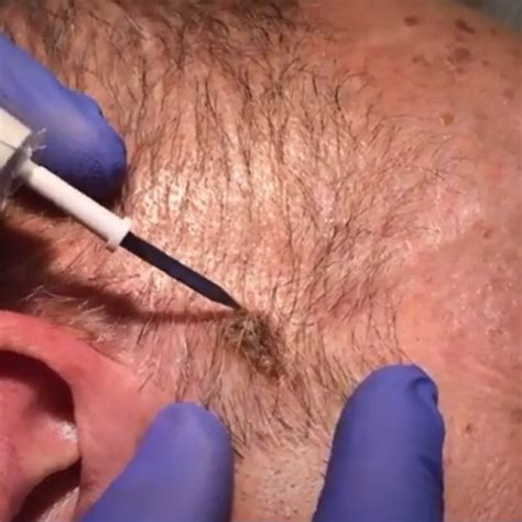 Seborrheic Keratosis Age Spots London Mole Removal