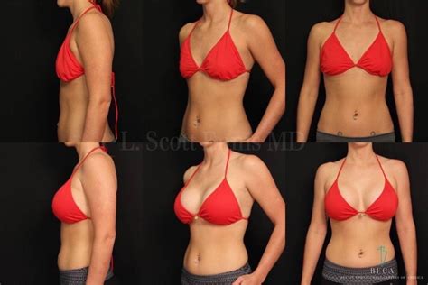 Breast Implants Surgery In Pakistan Cost For Breast Implants
