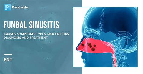 Fungal Sinusitis Causes Symptoms Types Risk Factors And More