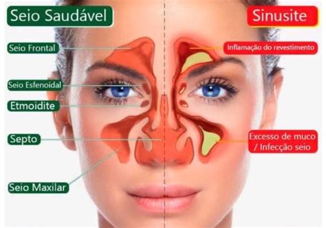 Saiba Como Tratar E Diferenciar Os Principais Tipos De Sinusite Notisul