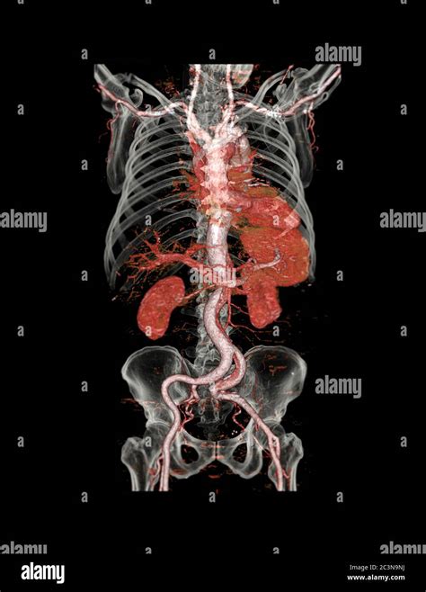 CTA Abdominal Aorta 3D Rendering Image Showing Aortic Dissection With