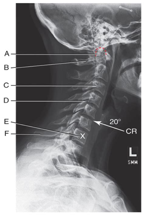 Lateral Cervical Spine Diagram Quizlet