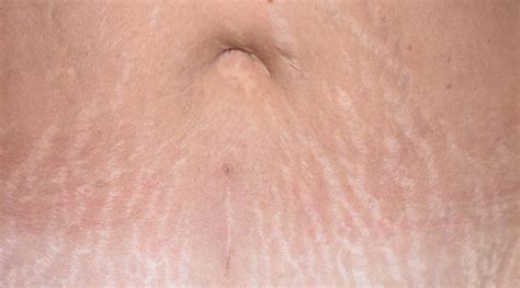 Stretch Marks Pure Dermatology Metairie LA