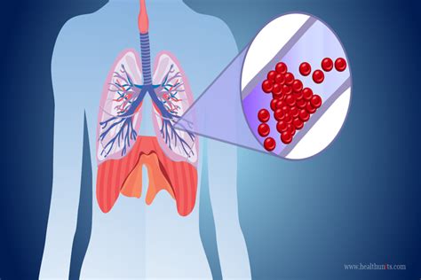 Embolia Pulmonar Embolia Pulmonar E Grave Veja O Que Eо NBKomputer