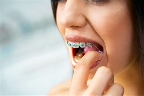 What Is The Purpose Of Rubber Bands In Braces Treatment Master