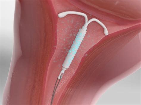 Video Hormonal IUD Intrauterine Device HealthClips Online