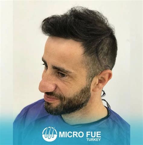 Bodrum Hair Transplant