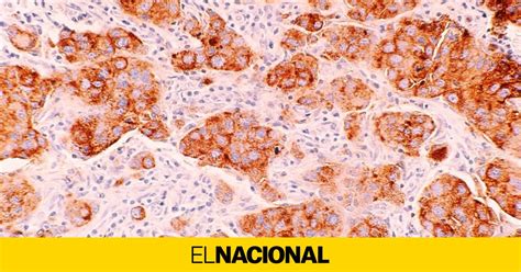 El riesgo de cáncer de mama se duplica en mujeres diagnosticadas con