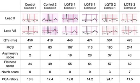 Congenital Long QT Syndrome ScienceDirect 49 OFF
