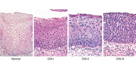 Cervical Intraepithelial Neoplasia CIN Medicoapps Org