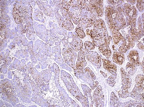 Pathology Outlines Large Cell Neuroendocrine Carcinoma