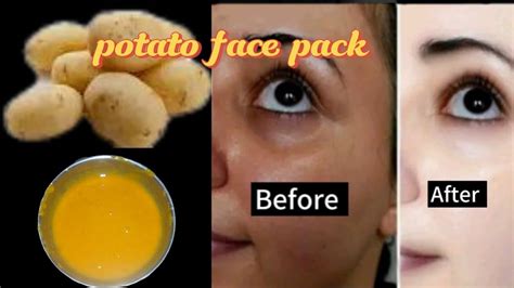 Potato Face Pack For Glowing Skin Pigmentation Acne Scars Melasma