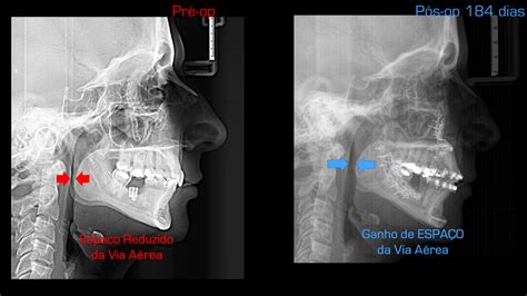 CIRURGIA ORTOGNÁTICA MINIMAMENTE INVASIVA E APNÉIA DO SONO O que você