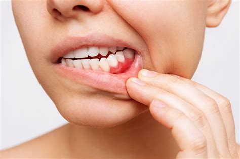 Gum Disease Treatment What You Need To Know And How Dr Singhs City