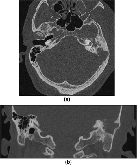 Acute Mastoiditis The Role Of Radiology Clinical Radiology