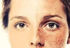 Welltox Crema Para Eliminar Pecas Y Otras Imperfecciones De La Piel