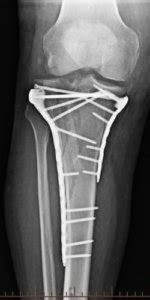 Tibial Plateau Fracture Diagnosis Treatments Reno Orthopedic Center