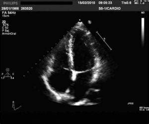 El ecocardiograma Imagen Diagnóstica