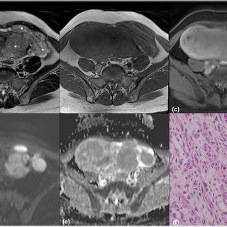 Leiomyosarcoma With Coagulative Necrosis In A 49 Year Old Woman MRI In