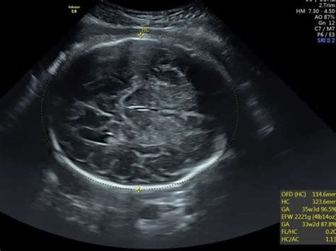 Our Growth Scan Explained Window To The Womb