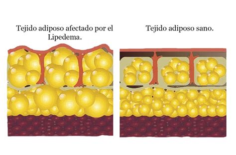 Fases Del Lipedema Clinica Lipedema Madrid