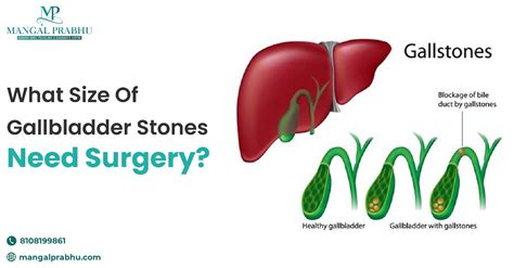 Gallbladder Stones What Size Requires Surgery