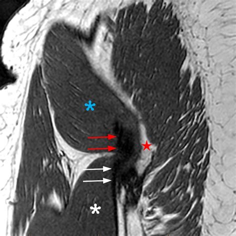 Gluteus Minimus Anatomy And Tear Patterns Radsource