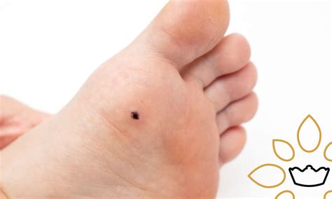 Verruga plantar síntomas cómo se contagia y cómo tratarla