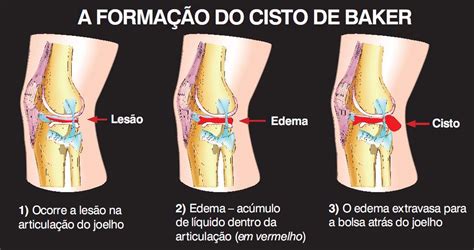 CISTO DE BAKER Você conhece Fisioterapia Dr Renato J Medeiros