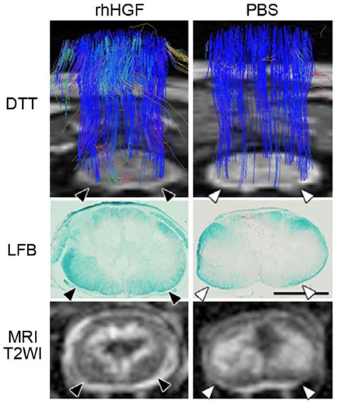 Diffusion Tensor Tractography DTT Showing Spinal Fibers Around The