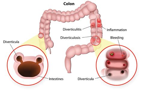 Diverticulitis Surgery Brisbane Sunnybank Surgical Group Brisbane