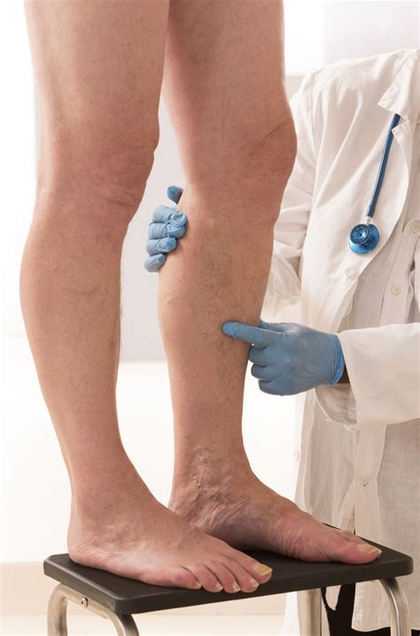 What Are The Treatment Options For Varicose Veins Top Varicose Vein