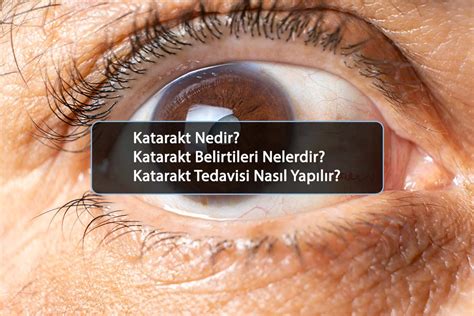 Katarakt Nedir Katarakt Belirtileri ve Tedavisi Nasıl Yapılır