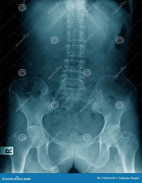 Imagen De La Radiograf A De La Espina Dorsal Lumbar Stock De