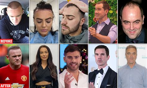 Celebrity Hair Transplant Before And After