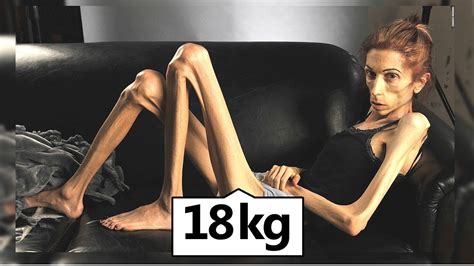 La Triste Vie De La Femme La Plus Maigre Du Monde YouTube