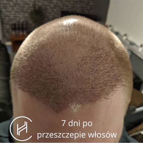 Przeszczep włosów gojenie i efekty krok po kroku Heva Clinic