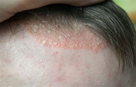 How To Treat Scabs On Your Scalp