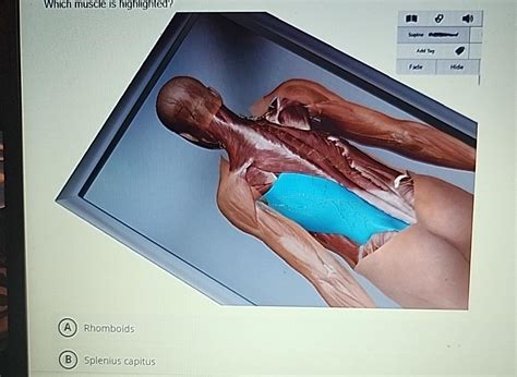 Solved Which Muscle Is Highlighted RhomboidsSplenius Capitus Chegg