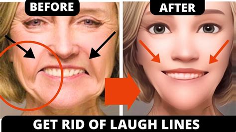 HOW TO GET RID OF NASOLABIAL FOLDS WITH FACE YOGA SMILE LINES